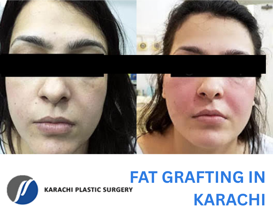 Fat Grafting in Karachi: Natural Enhancement for Face and Body ...